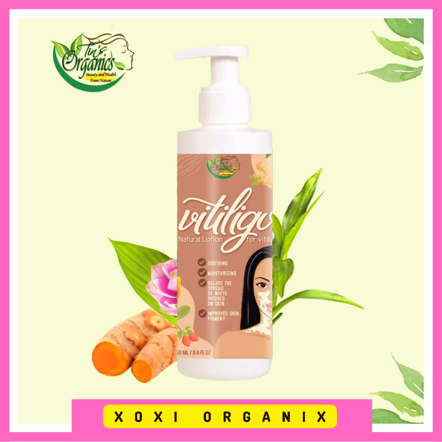 Vitiligo Herbal Lotion 250 ml | Organic Treatment Lotion for Vitiligo ...