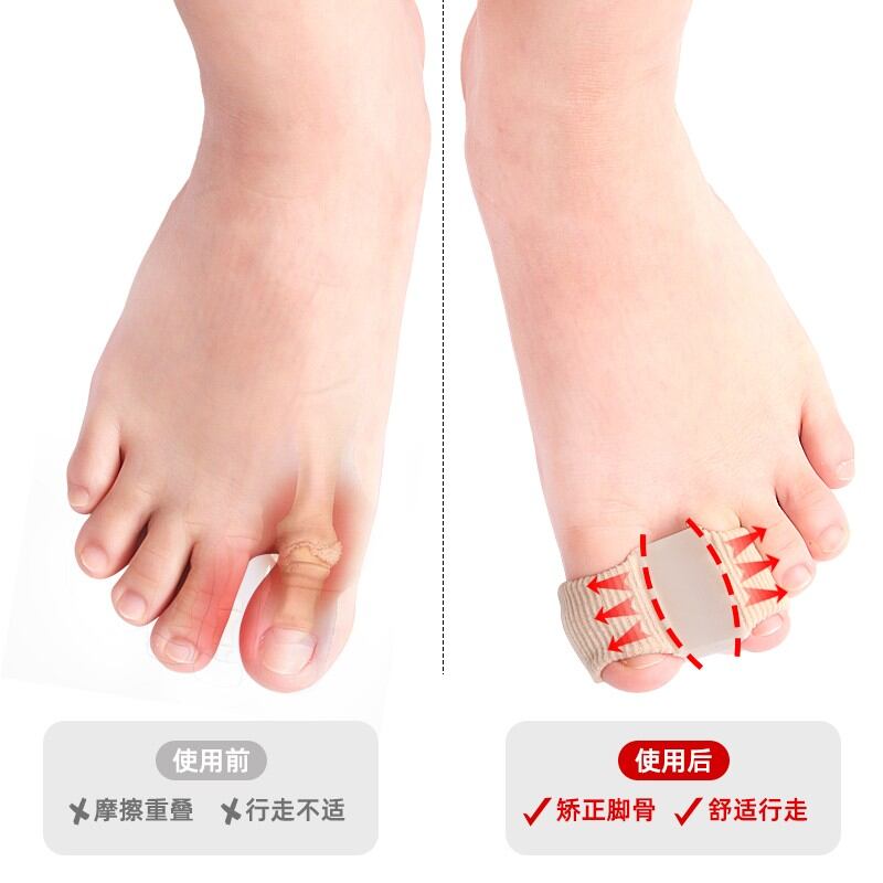 Fiberglass Double Hole Toe Separator for Bunion Straightening Female ...