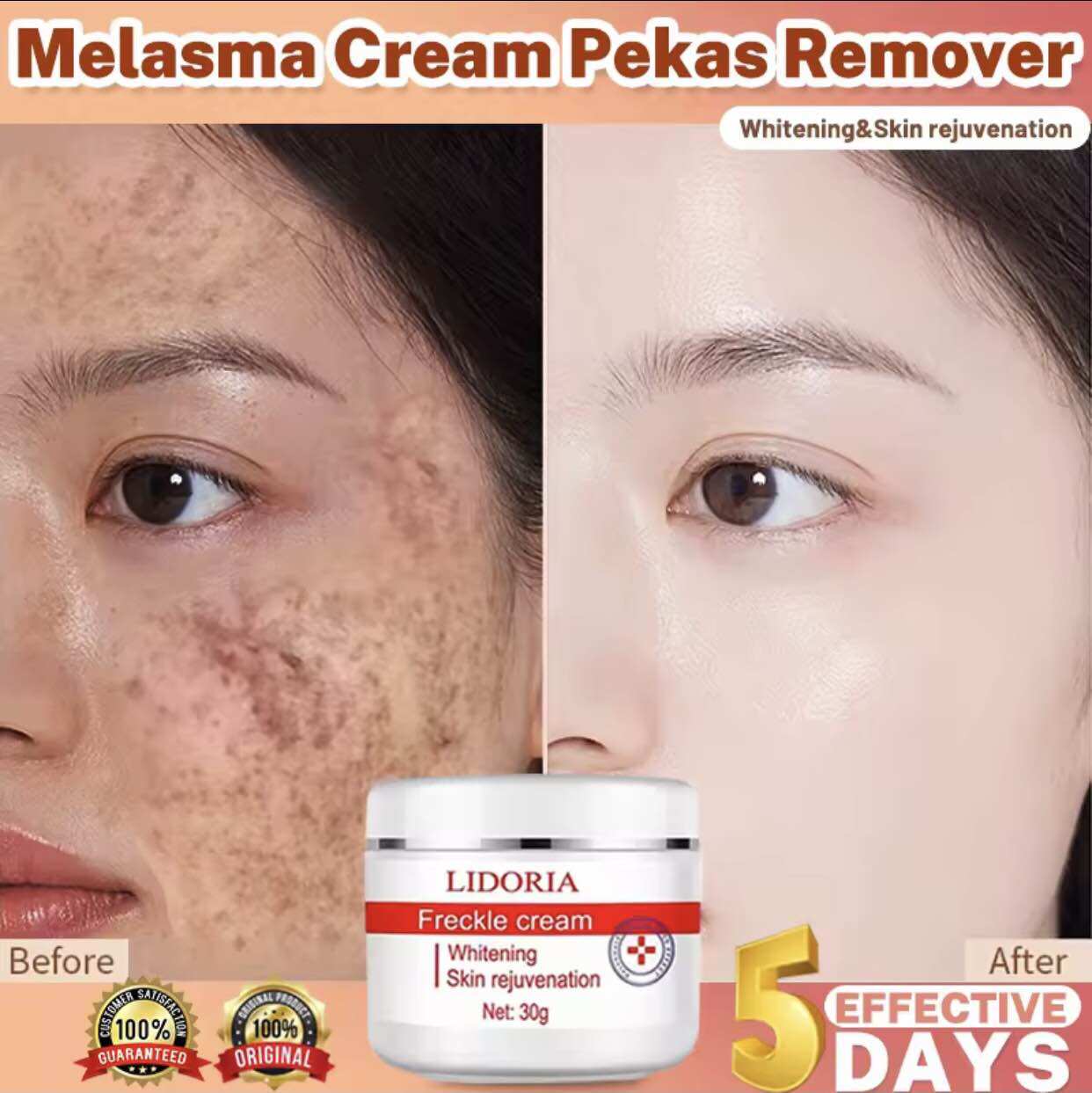 LIDORIA Freckle Cream / Melasma Cream Pekas Remover 30 G | Lazada PH