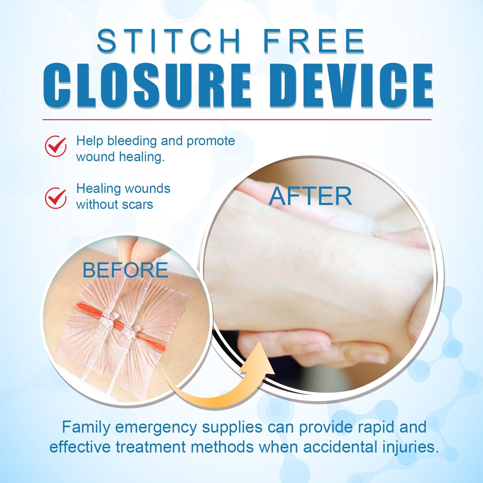 South Moon Portable Wound Closure Patch Painless Suture Zipper Band-Aid ...